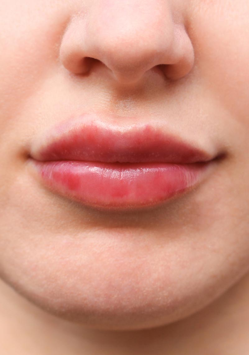 Best Filler Migration Windsor The Facebible Surrey